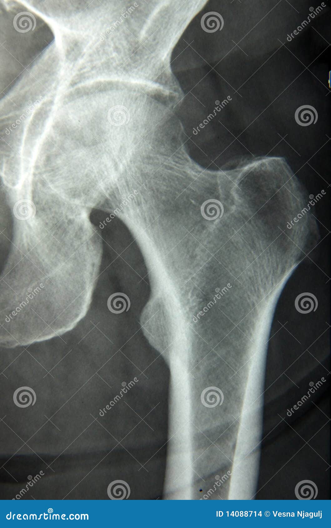 Raggi X Dell'anca, Radiologia Classica Fotografia Stock - Immagine di ...