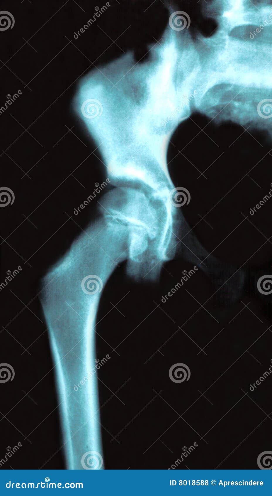 Raggi X Dell'anca - Vista Frontale Fotografia Stock - Immagine di ...