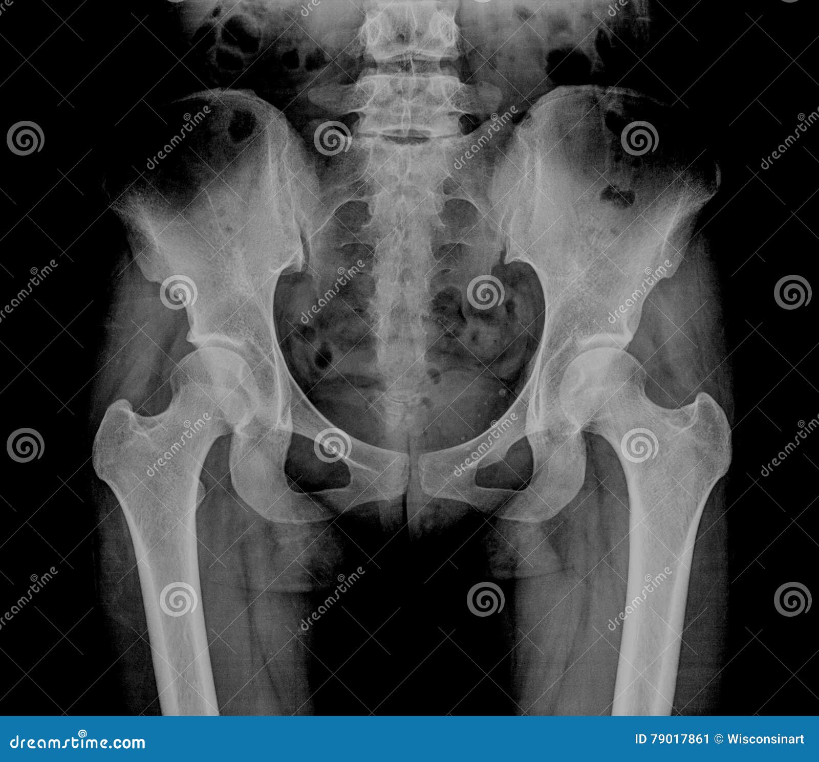 Raggi X Dell'osso Iliaco, Corpo Umano Immagine Stock - Immagine di osso ...