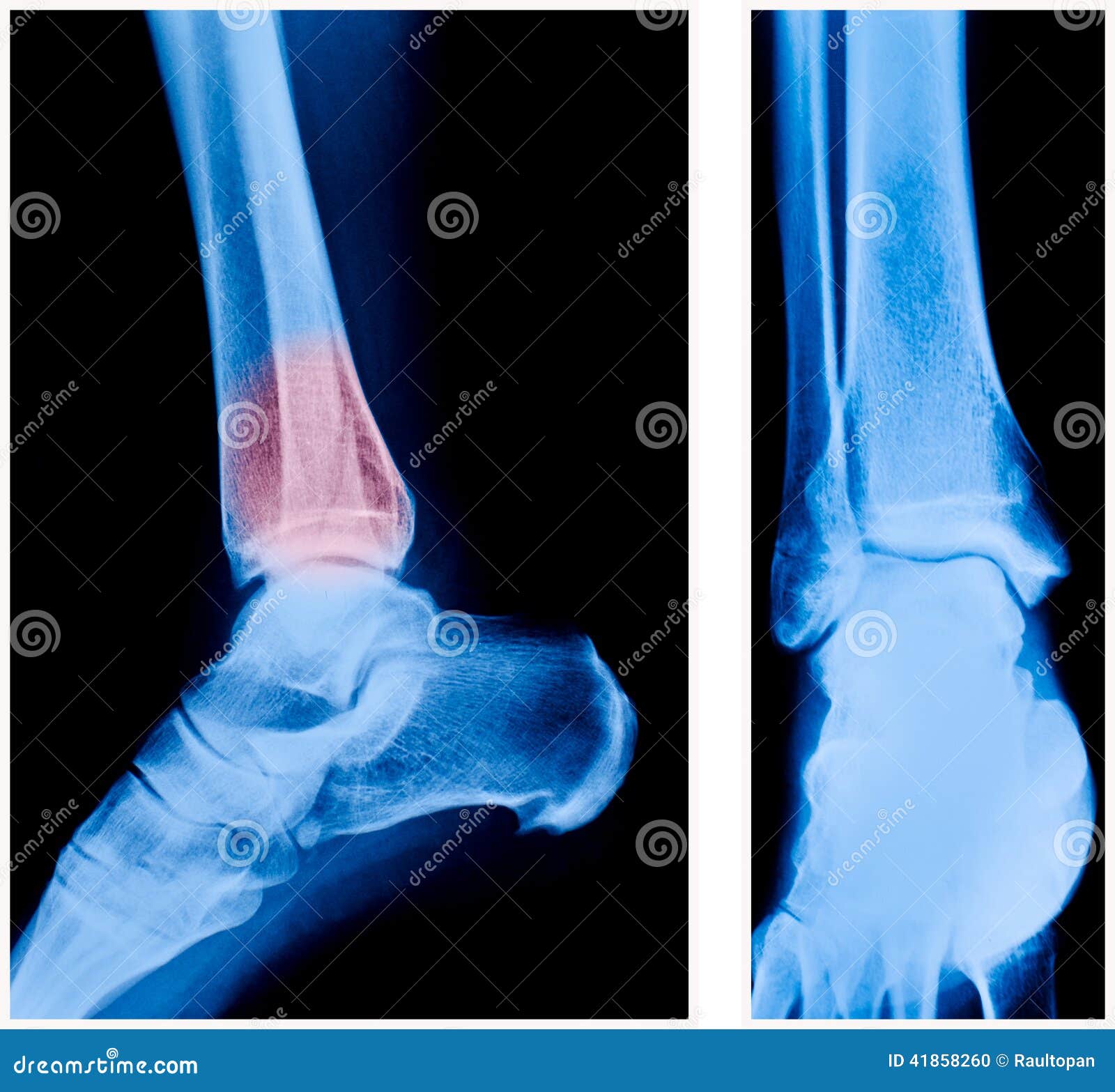 Raggi x della caviglia fotografia stock. Immagine di ospedale - 41858260