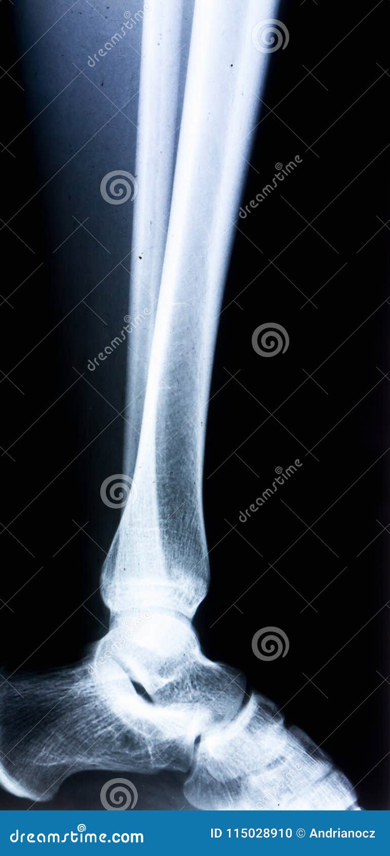 Raggi x della gamba umana fotografia stock. Immagine di diagnosi ...