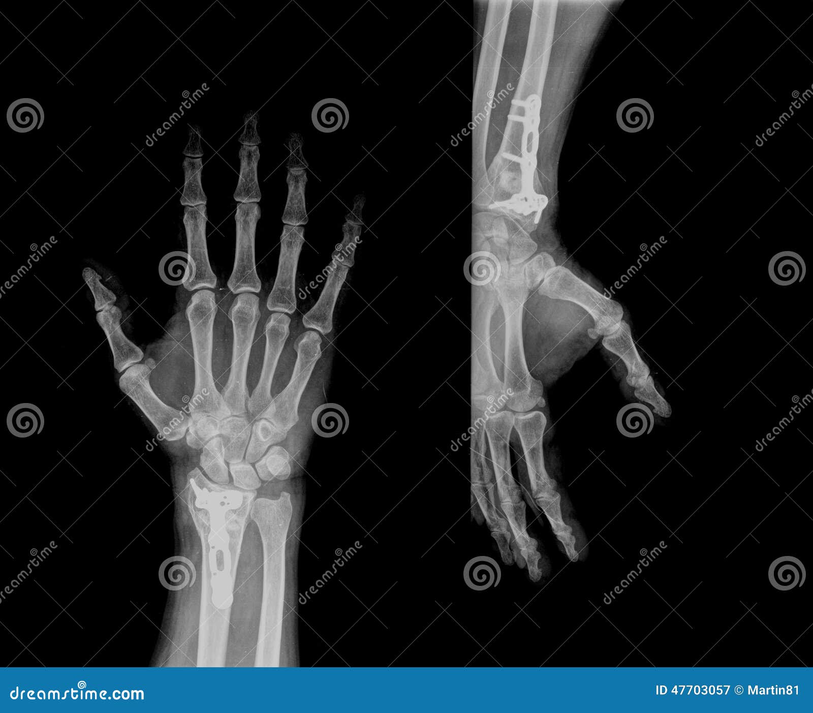 Raggi X della mano immagine stock. Immagine di medicina - 47703057