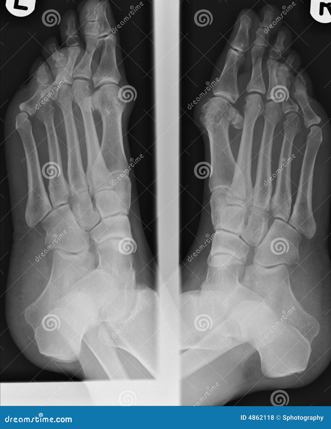 Raggi X Delle Borsiti Dell'alluce Fotografia Stock - Immagine di dolore ...