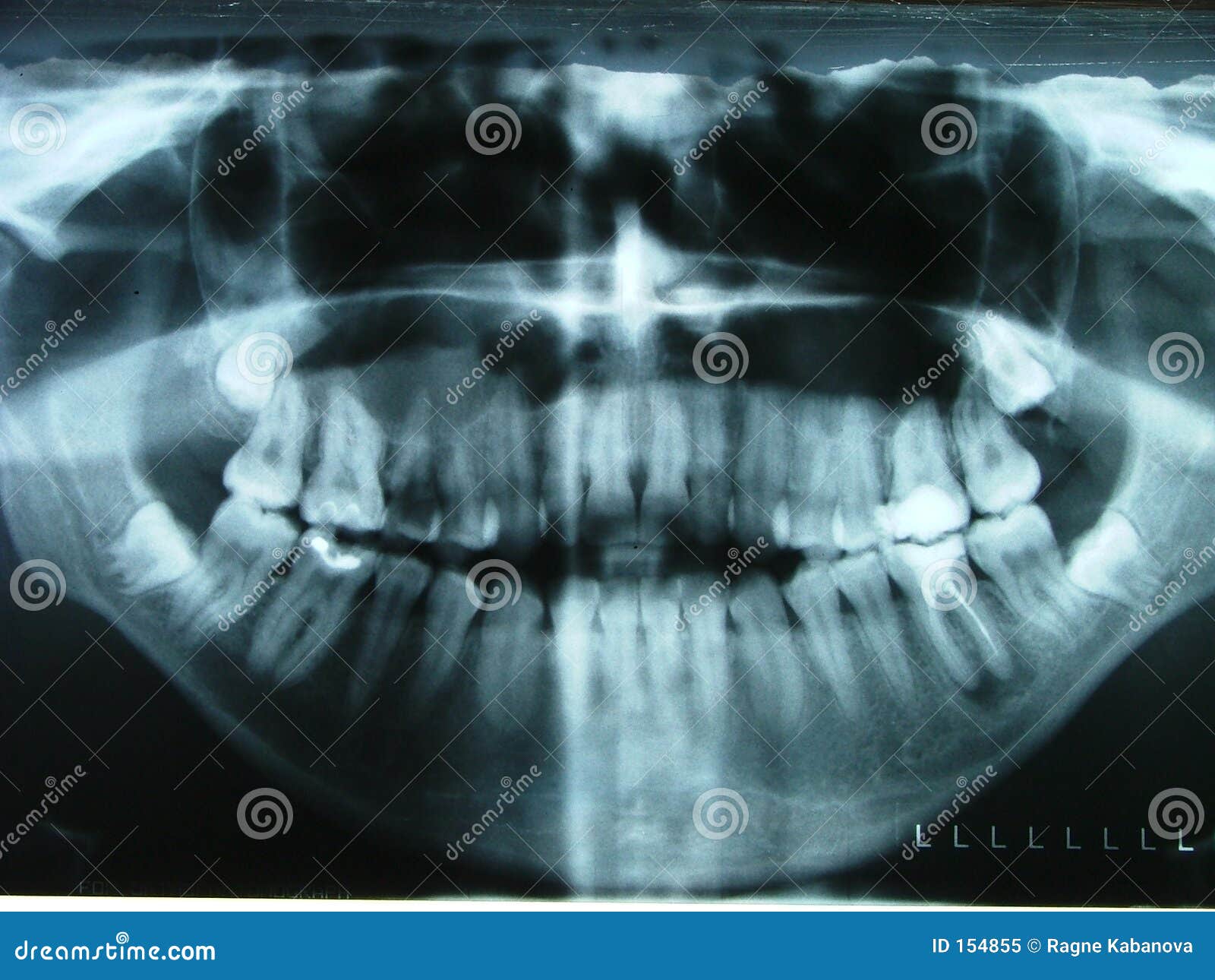 Raggi X immagine stock. Immagine di clinica, ferita, interno - 154855