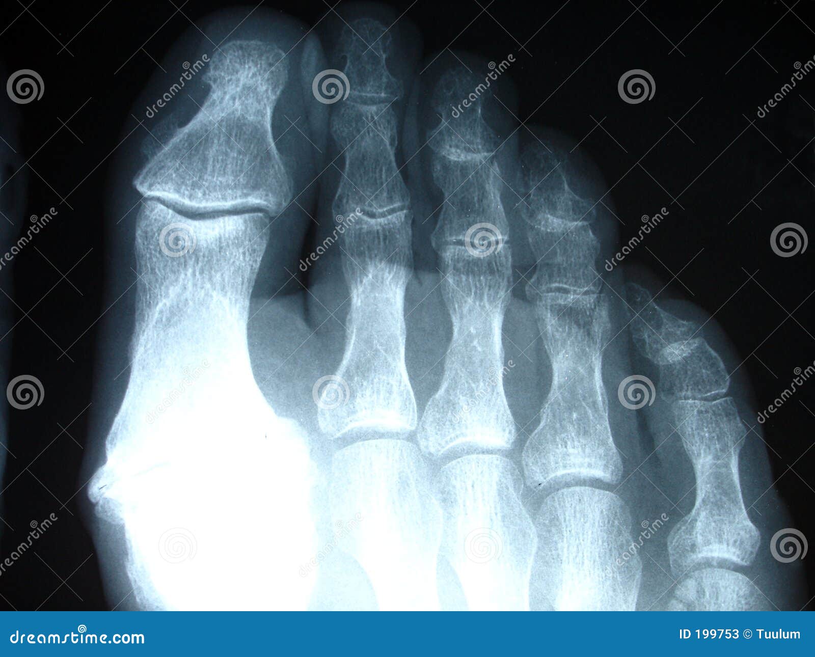 Raggi X immagine stock. Immagine di piede, diagnostico - 199753
