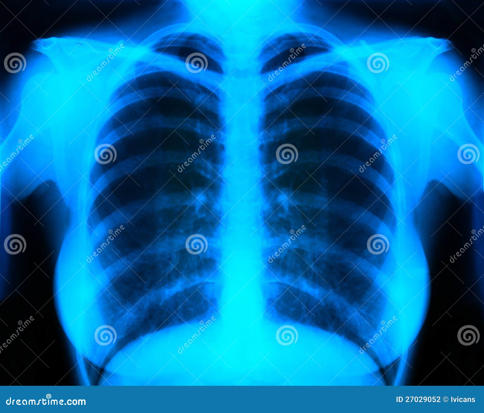 Raggi X fotografia stock. Immagine di polmone, malattia - 27029052