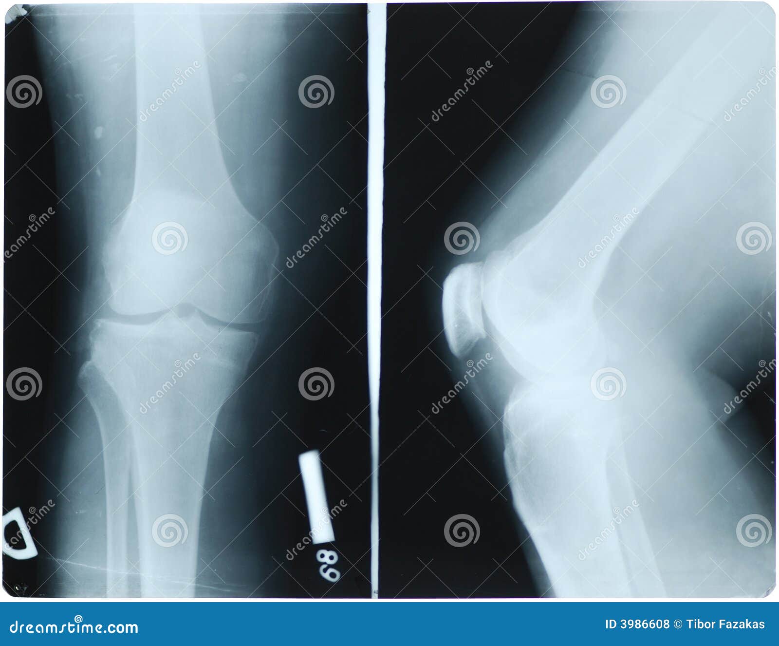 Raggi X fotografia stock. Immagine di rotto, salute, medico - 3986608