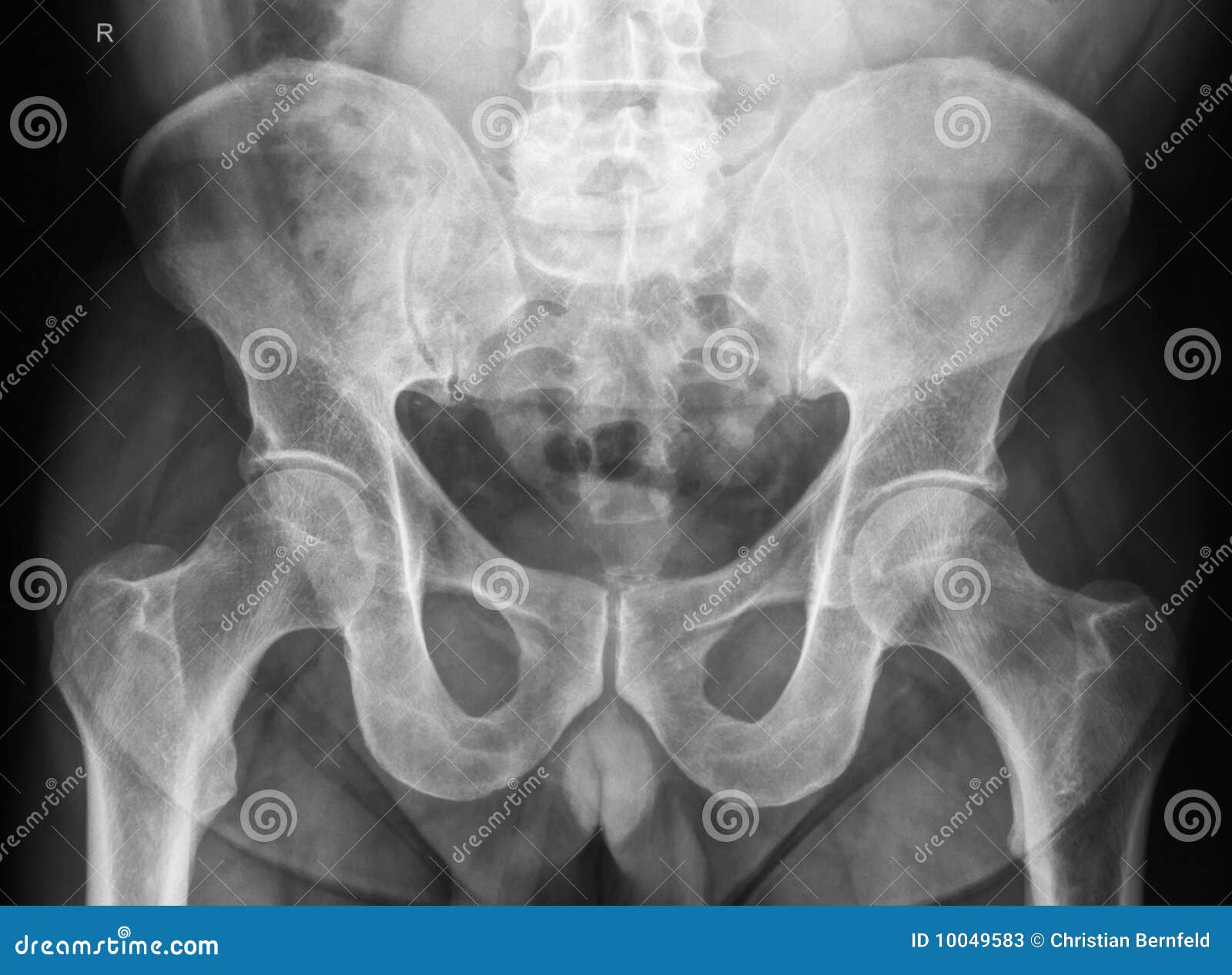 Raggi X maschii del bacino immagine stock. Immagine di radiologia ...