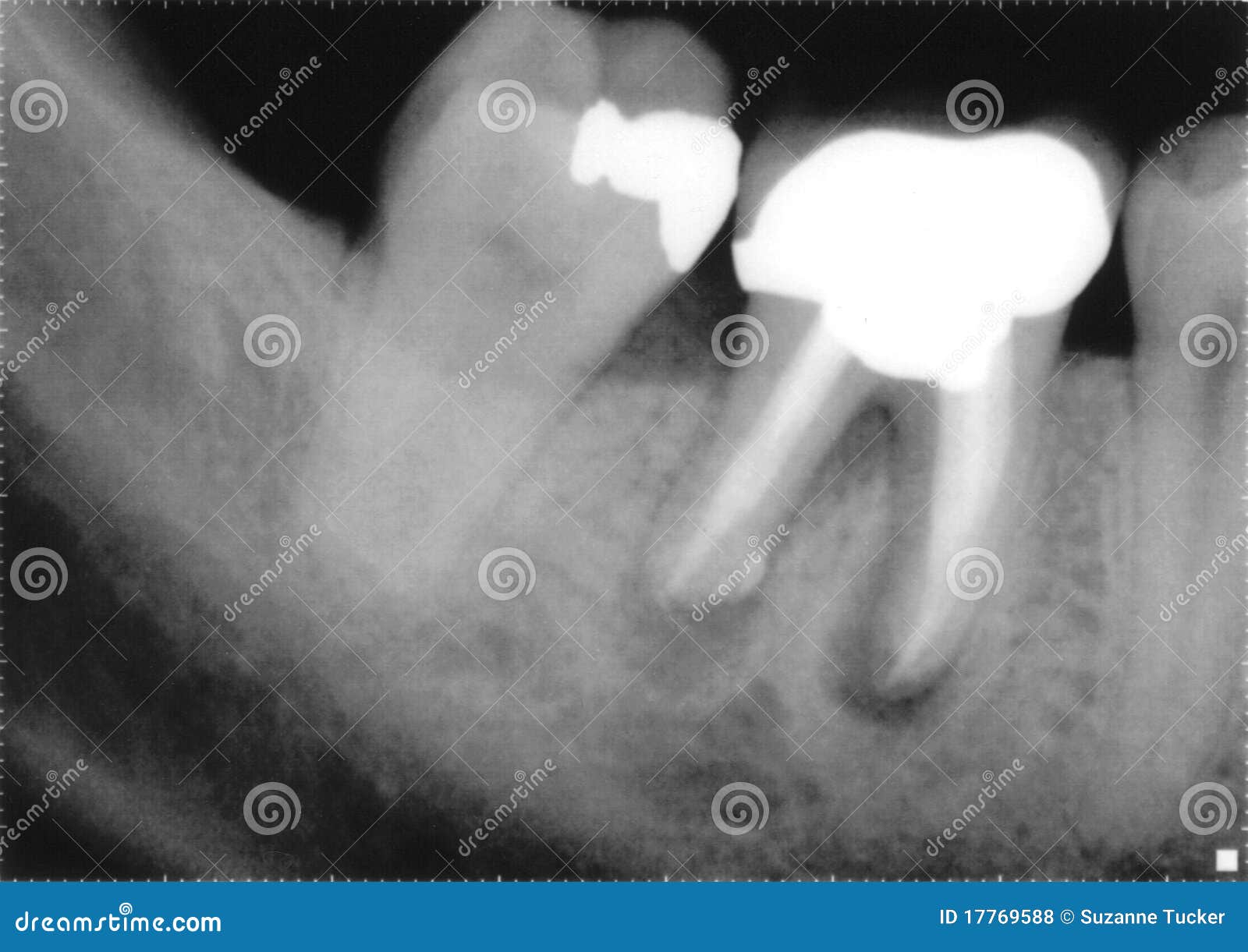 Raia X dos molars foto de stock. Imagem de radiologia - 17769588