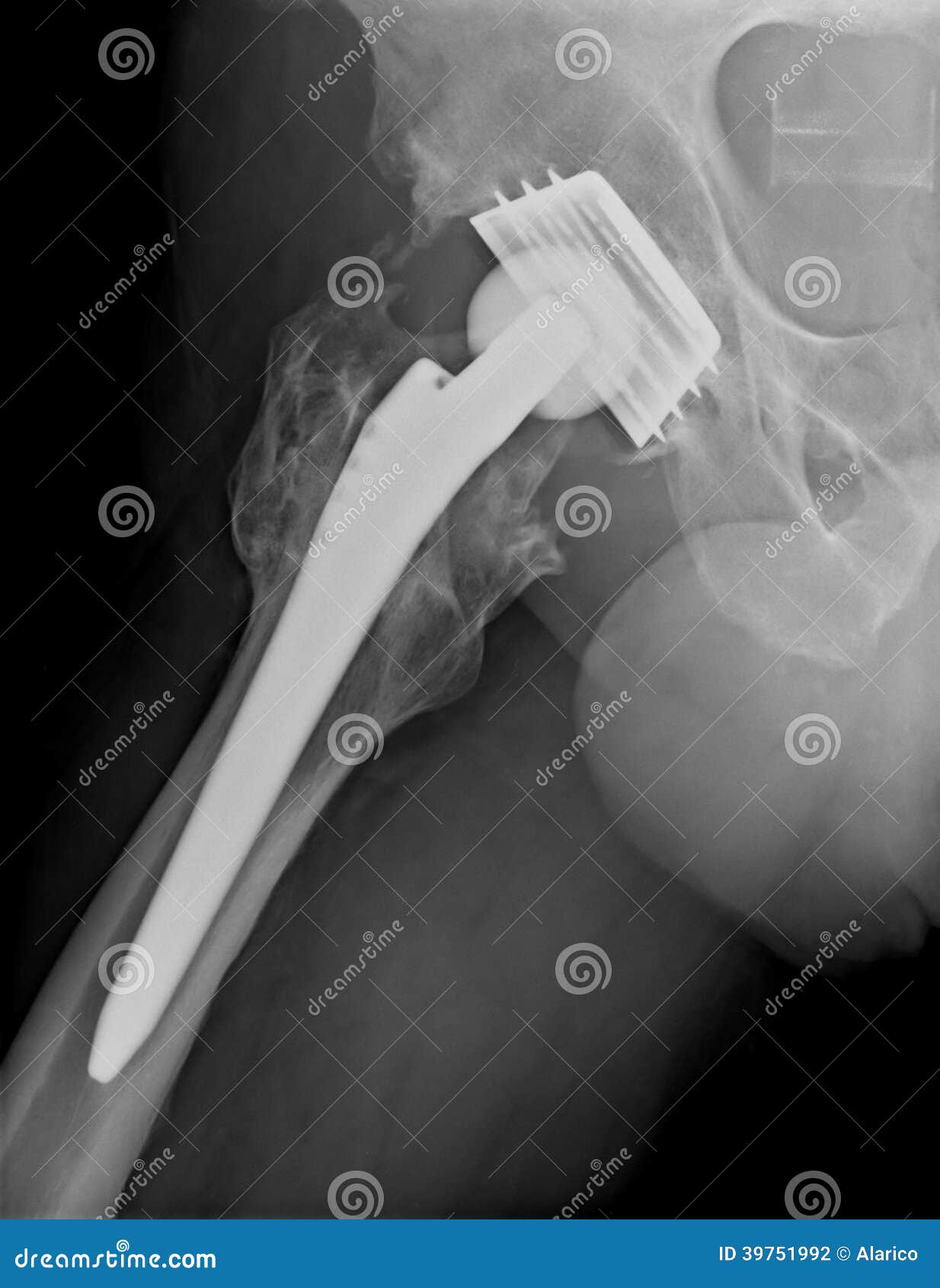 Raio X Anca Total Permanente Da Artroplastia Foto de Stock - Imagem de ...
