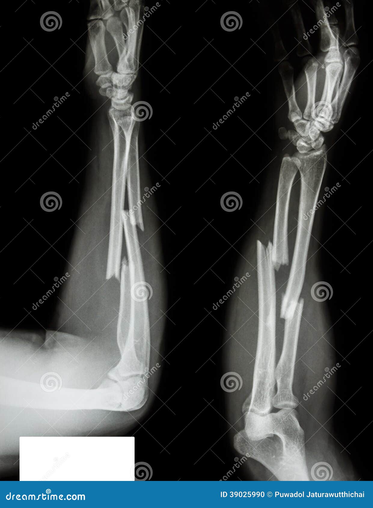 Fratura Do Osso Da Ulna Fratura Do Rádio E Da Ulna Qual O