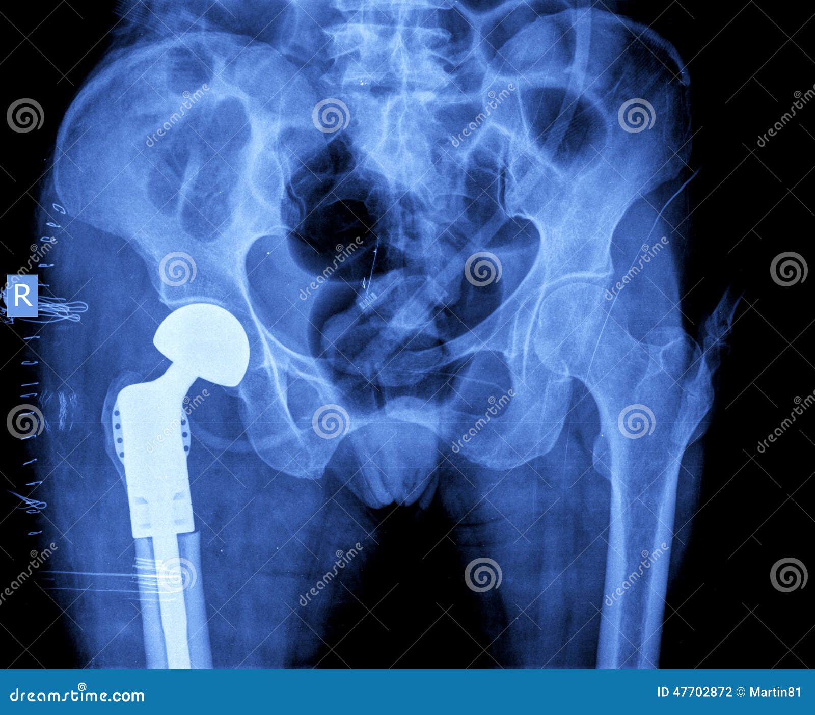 Raio X da prótese anca foto de stock. Imagem de osteoporose - 47702872