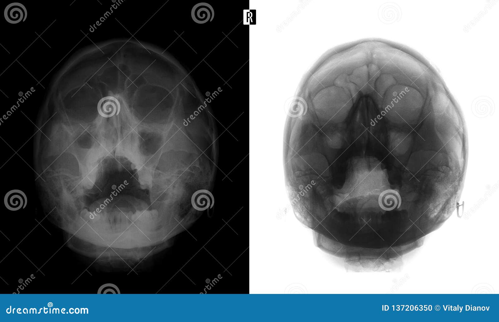 Sinusopatia Maxilo Etmoidal Bilateral - RETOEDU