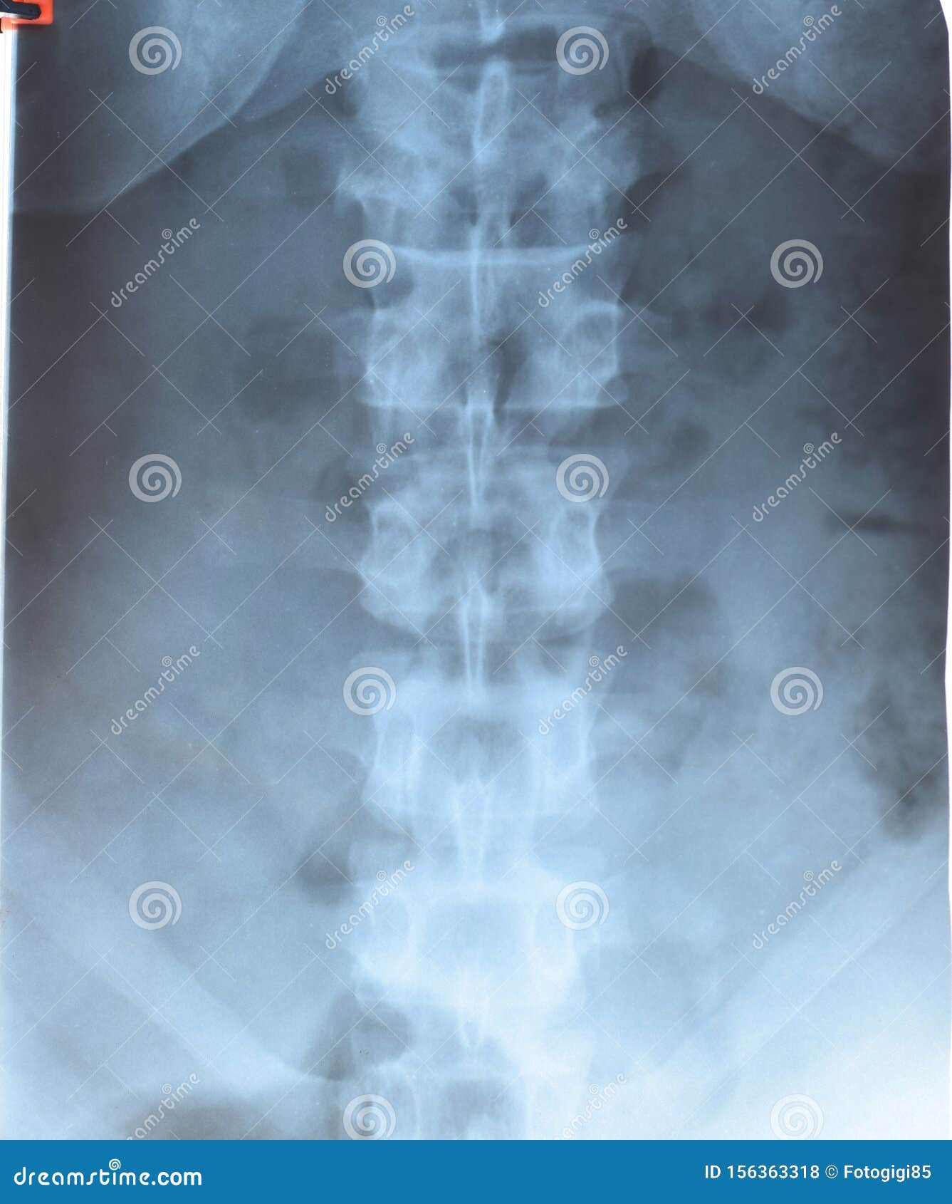 Raio X Do Lombar, Coluna Em Raios X Foto de Stock - Imagem de pélvis ...