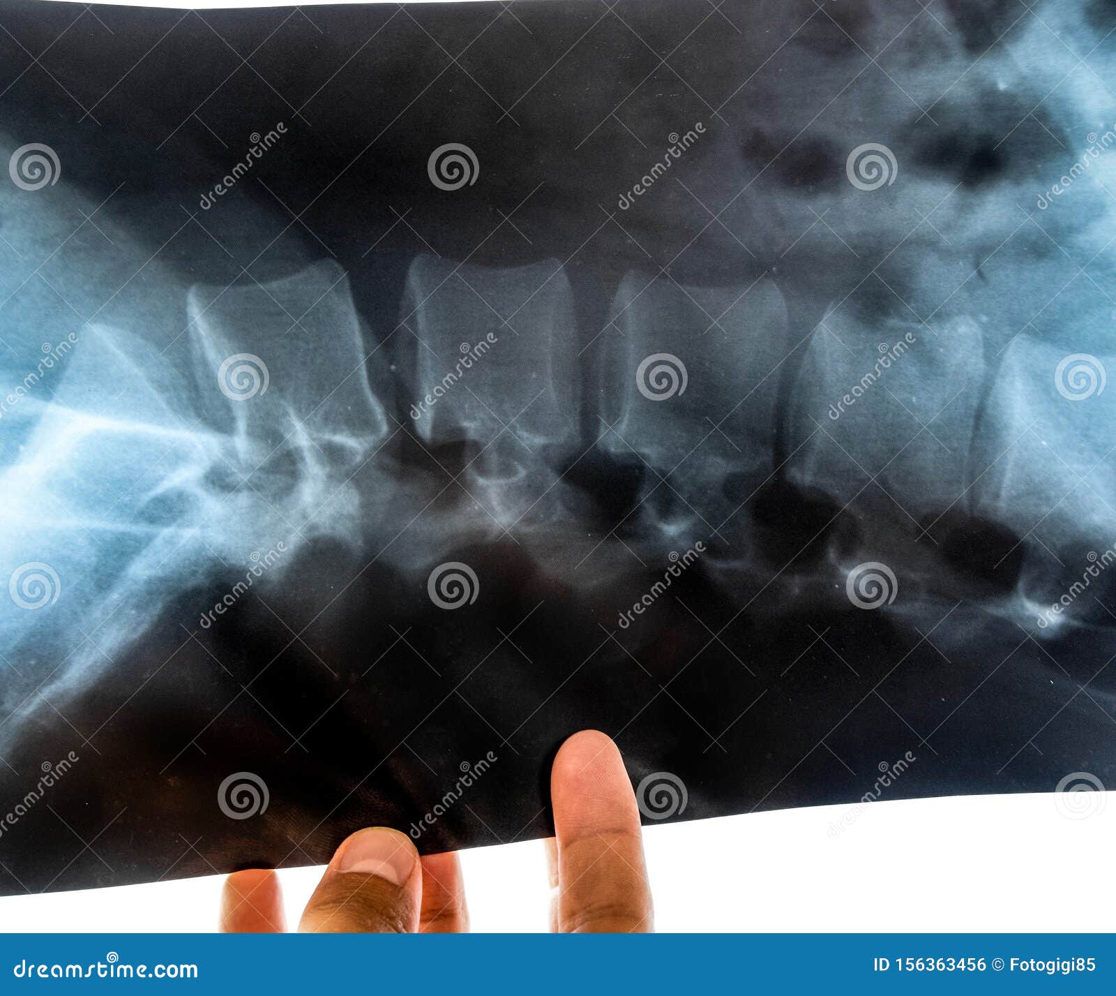 Raio X Do Lombar, Coluna Em Raios X Foto de Stock - Imagem de medicina ...