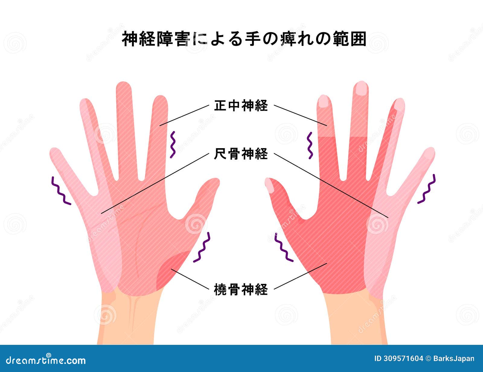 Hand Numbness. Cartoon Numb Hands Or Joints Pain Sensation, Aching ...