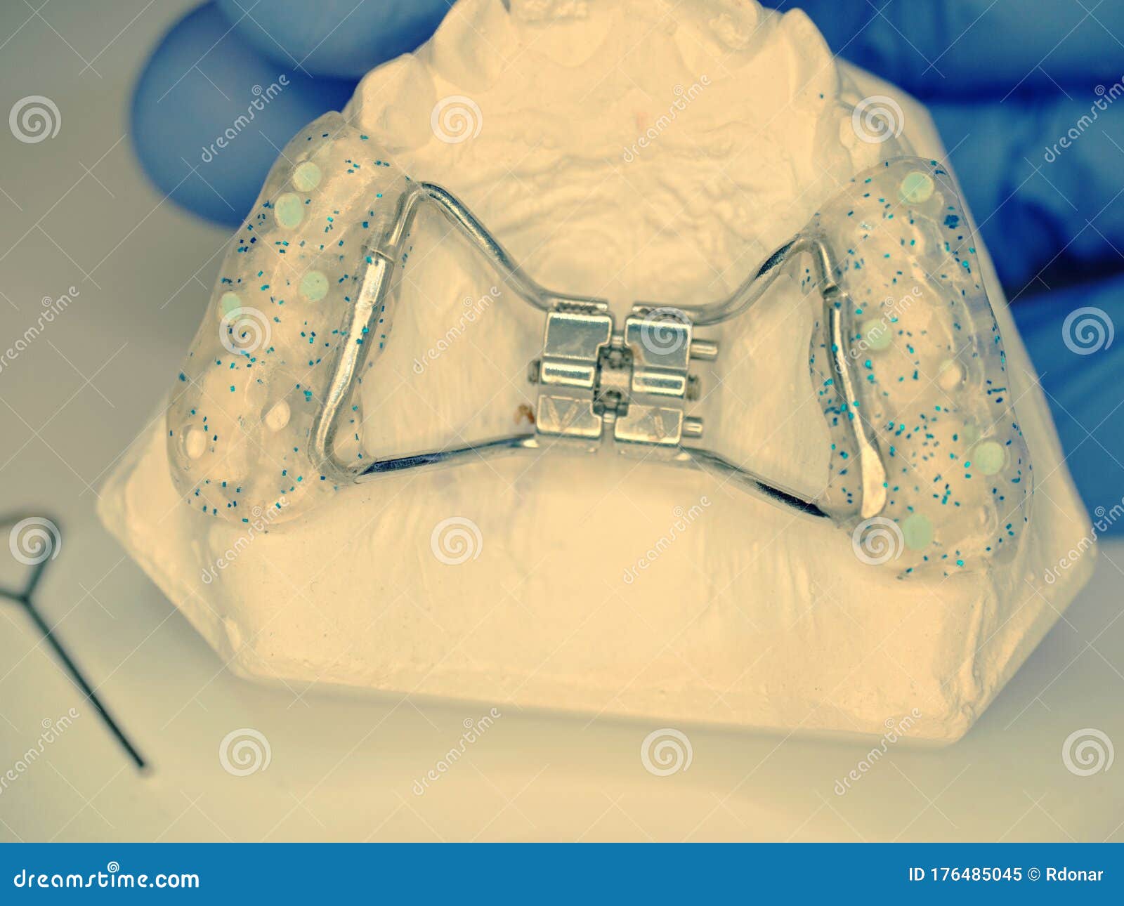 Rapid Palatal Expander Set on Teeth Cast Stock Image - Image of medical ...