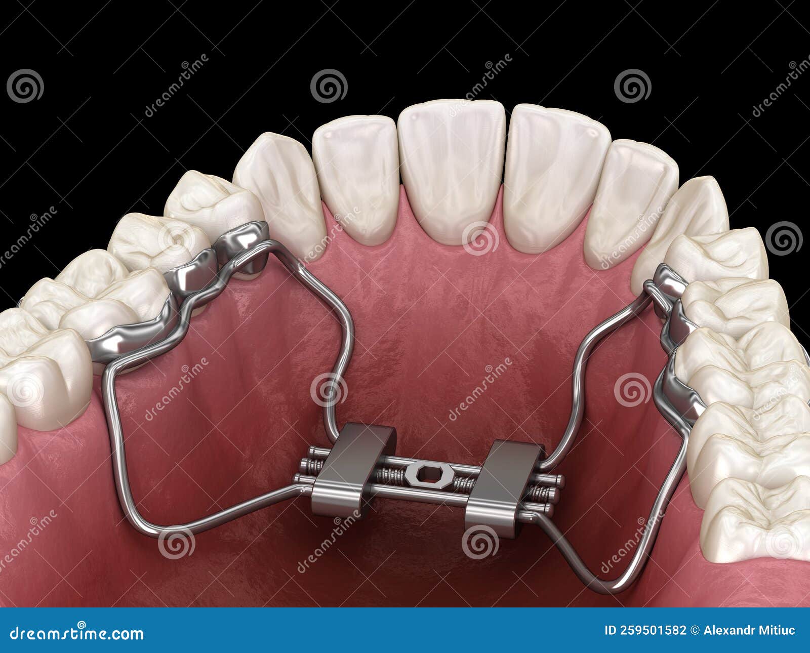 Rapid Palatal Expansion. Medically Accurate Tooth 3D Illustration Stock ...