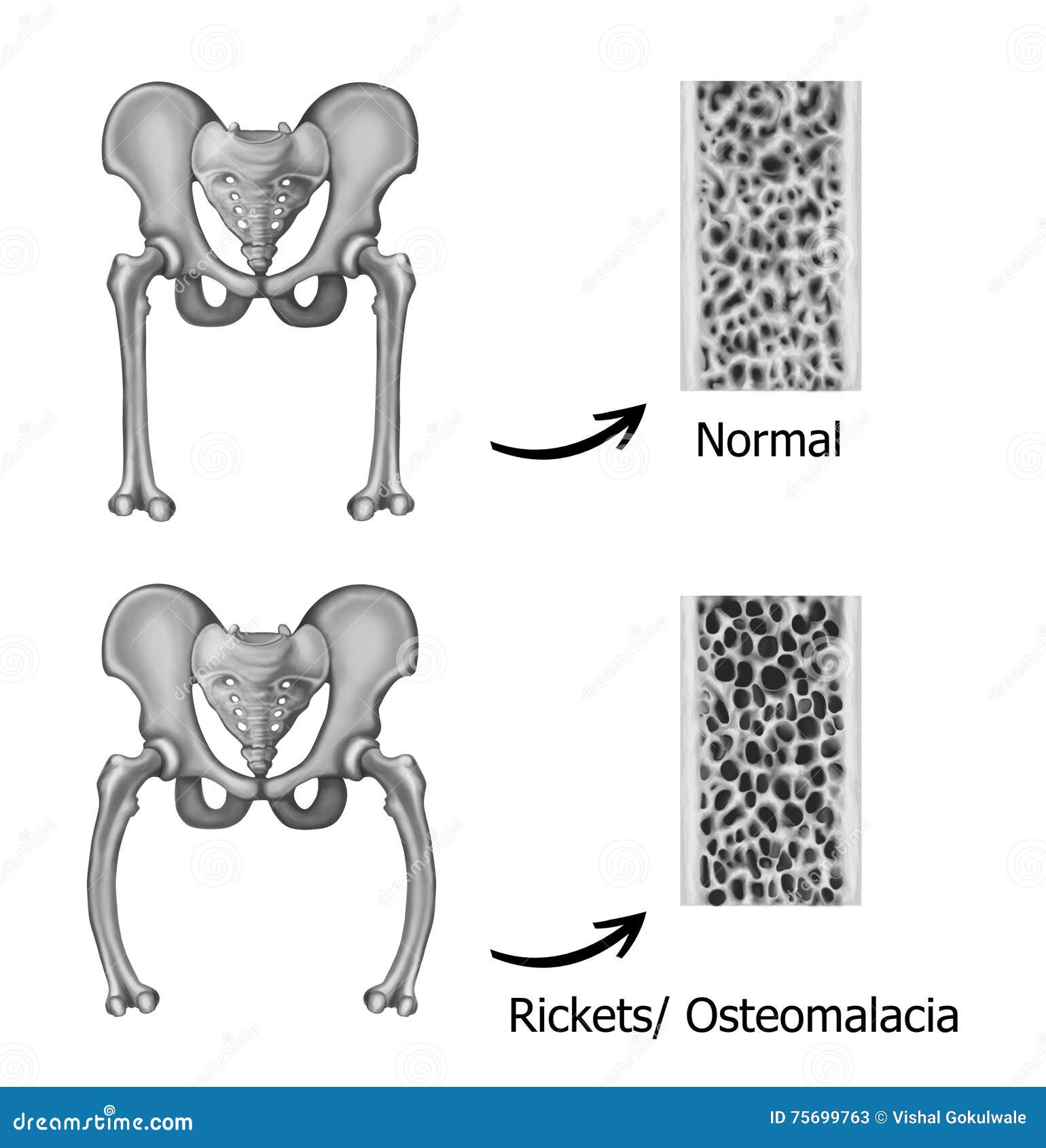 Raquitismo-osteomalacia stock de ilustración. Ilustración de defecto ...