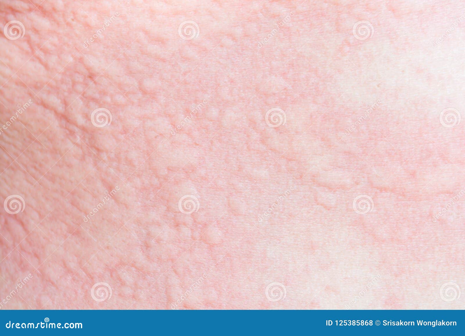 Rash, in the Skin, and Itching. Stock Photo - Image of medicine, body ...