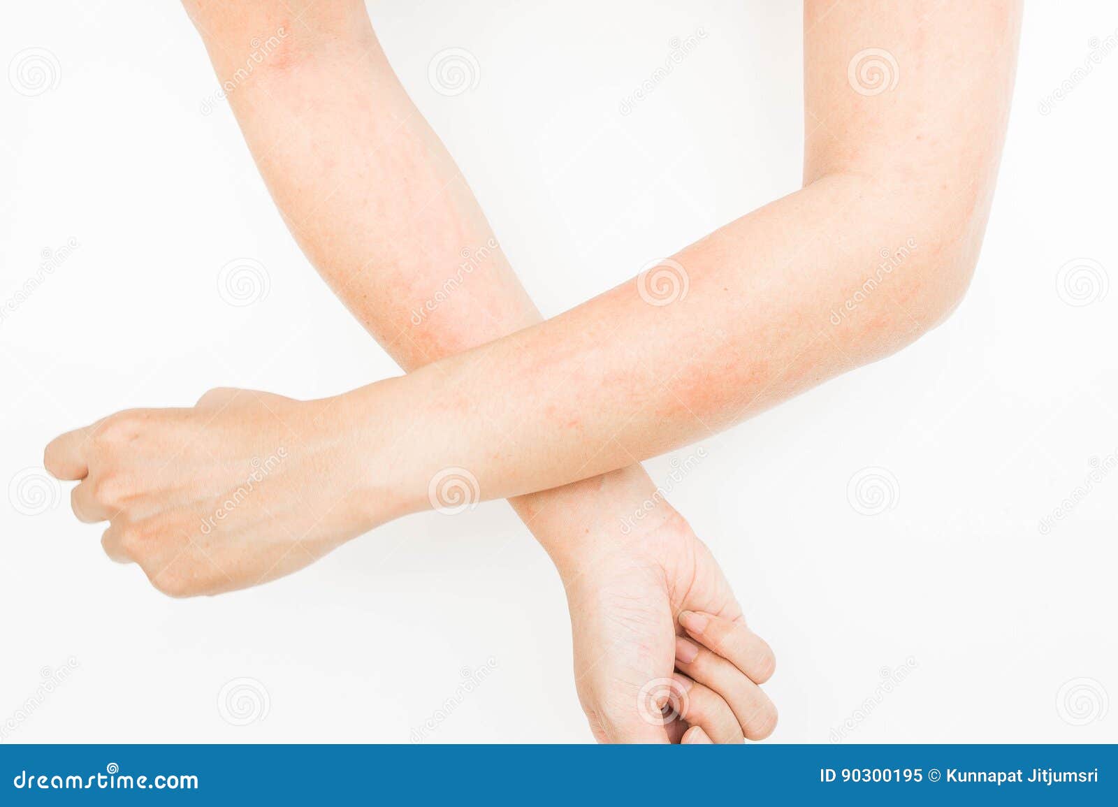 Rash Allergy from Touching Arms ,eczema, Dermatitis Stock Image - Image ...