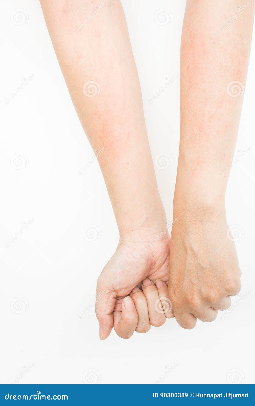 Rash Allergy from Touching Arms ,eczema, Dermatitis Stock Image - Image ...