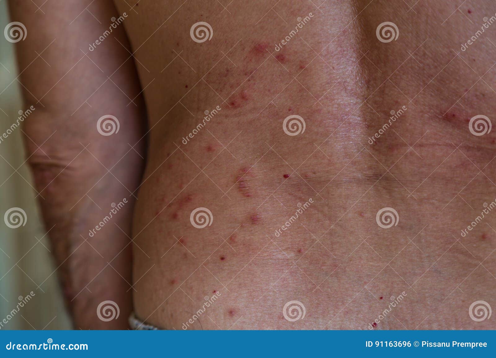 Rash on back skin stock photo. Image of medical, medicine - 91163696