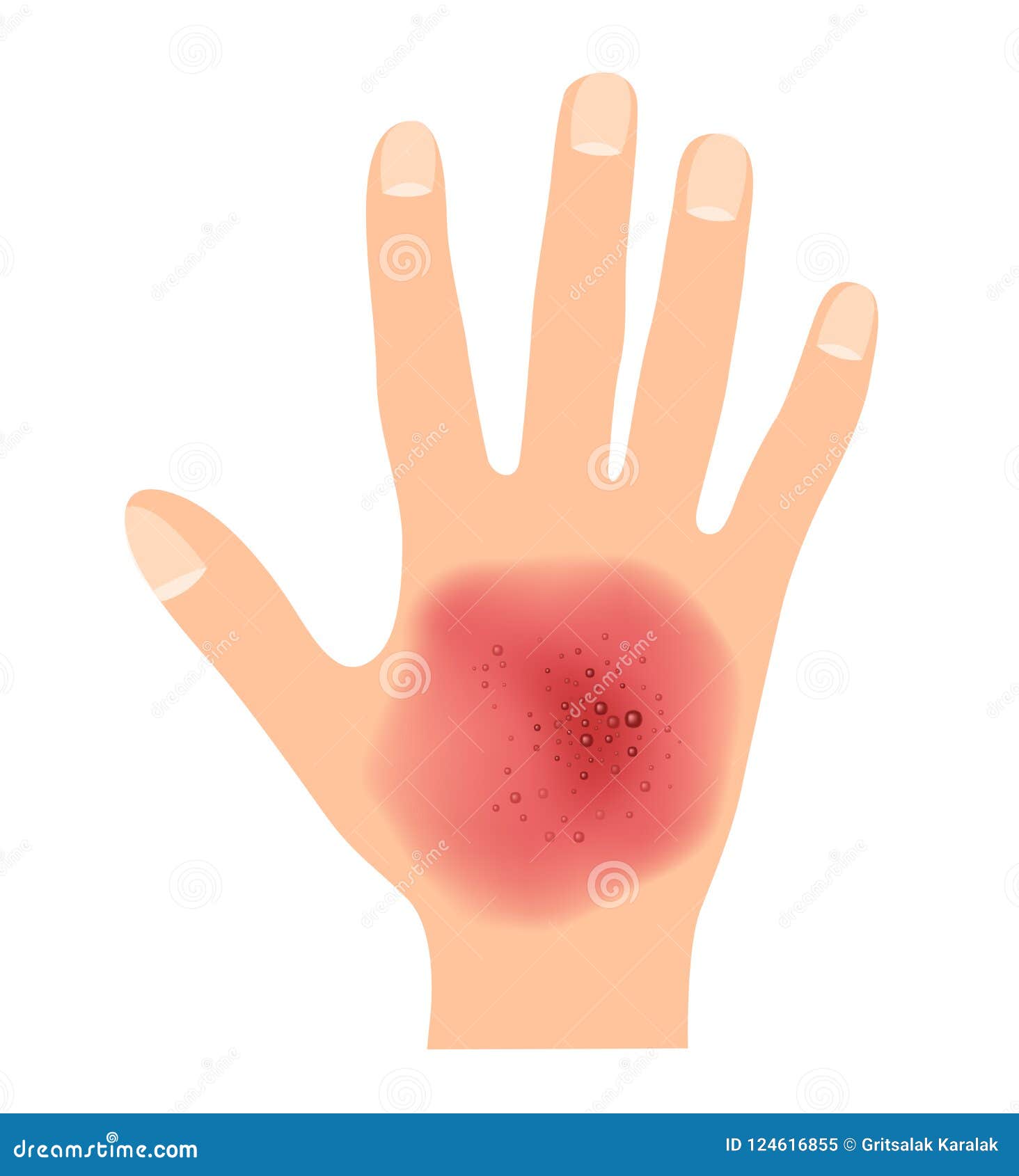Rash on hand skin stock vector. Illustration of medical - 124616855