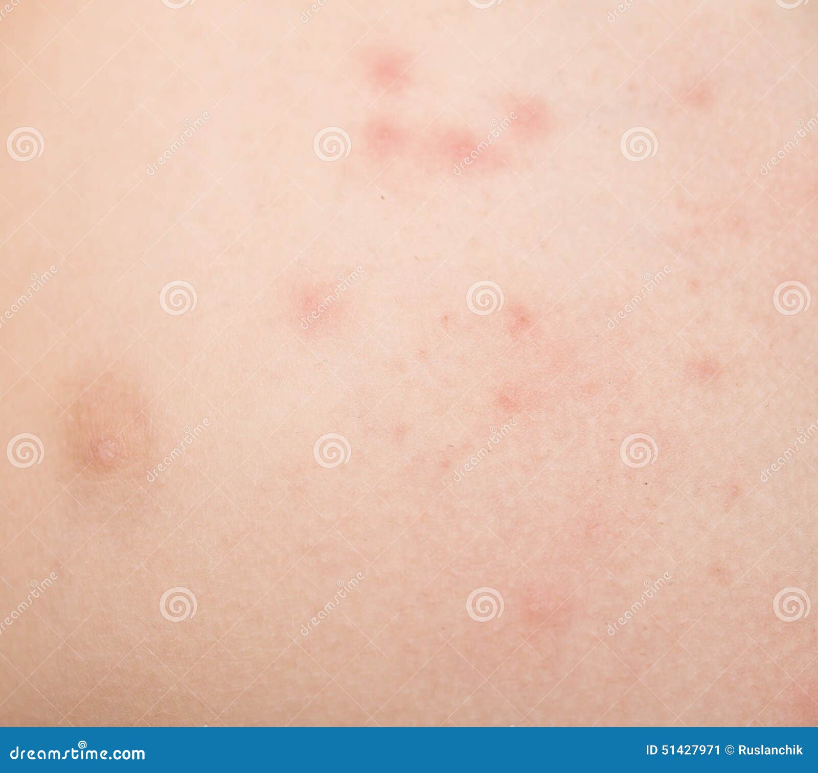 Rash stock image. Image of head, health, condition, symptom - 51427971