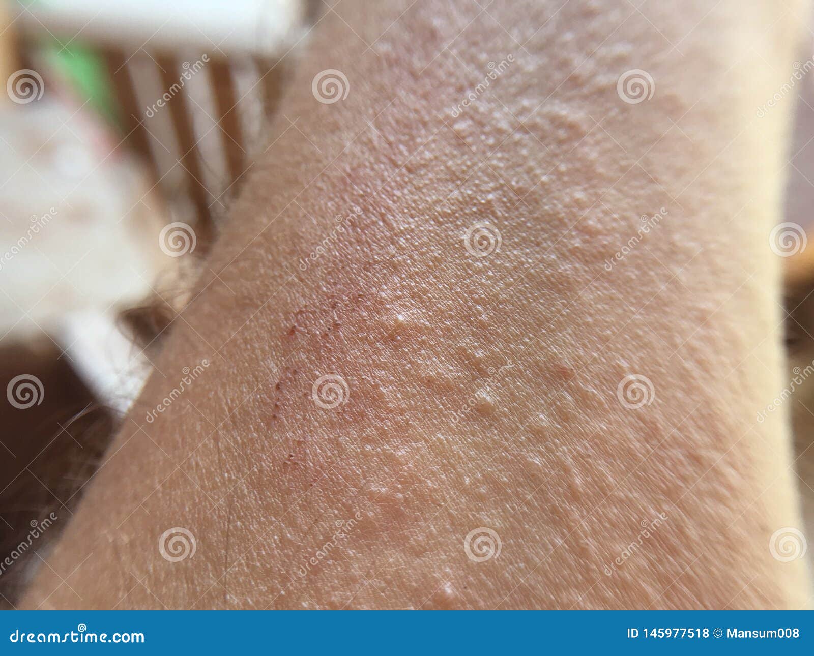 Rash on man hand stock photo. Image of itchy, dermatitis - 145977518