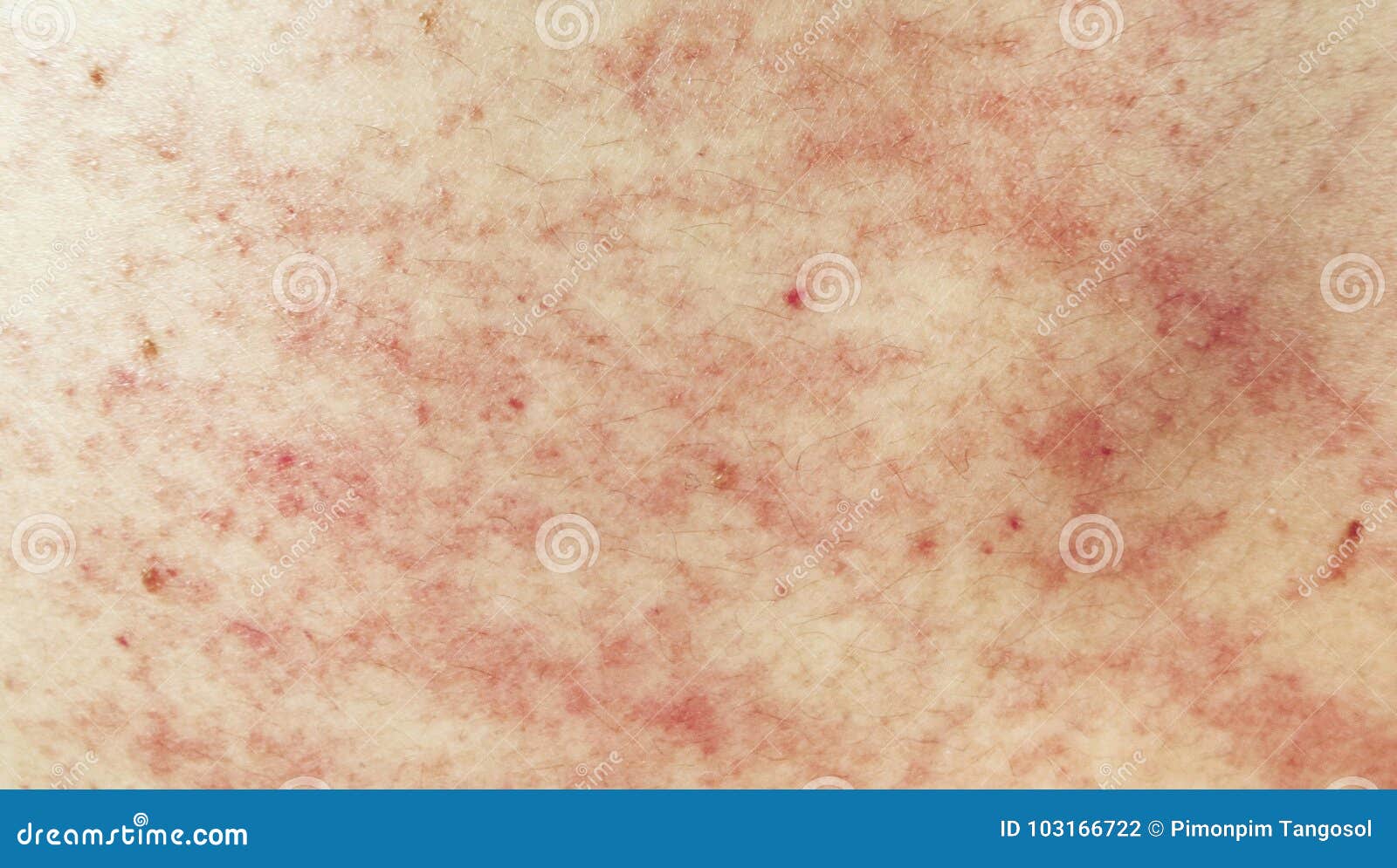 Rash on sensitive skin stock photo. Image of female - 103166722
