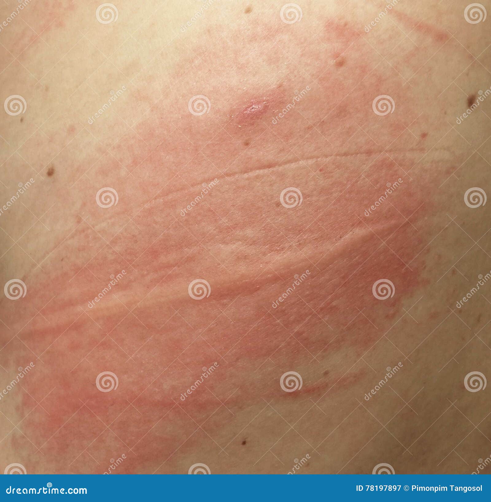 Rash on sensitive skin stock image. Image of itchy, people - 78197897