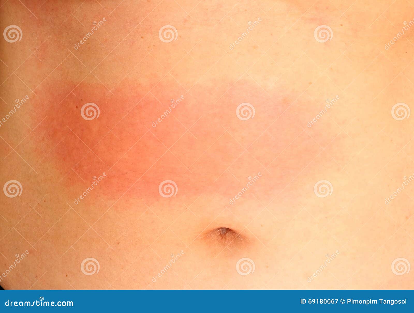 Rash on sensitive skin stock image. Image of allergic - 69180067