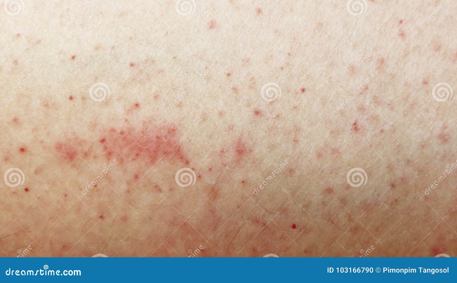 Rash on sensitive skin stock photo. Image of dermatology - 103166790