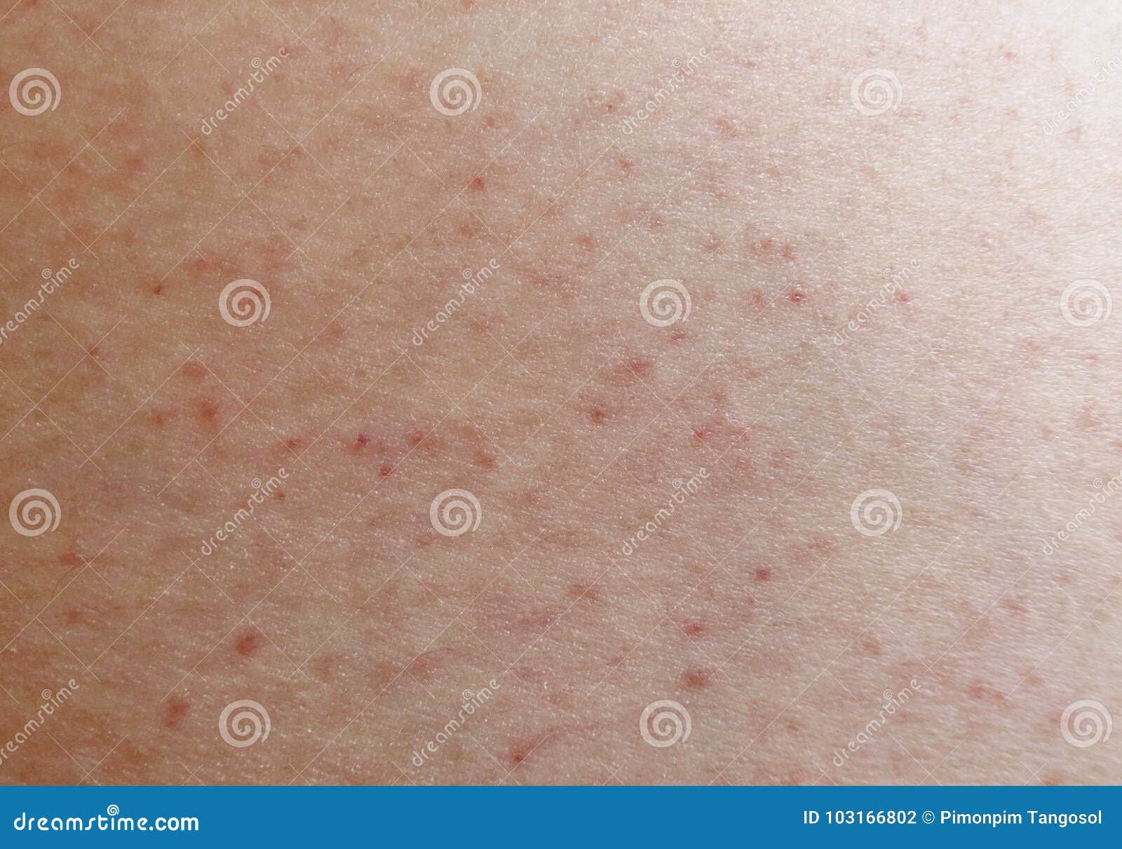 Rash on sensitive skin stock photo. Image of spotty - 103166802