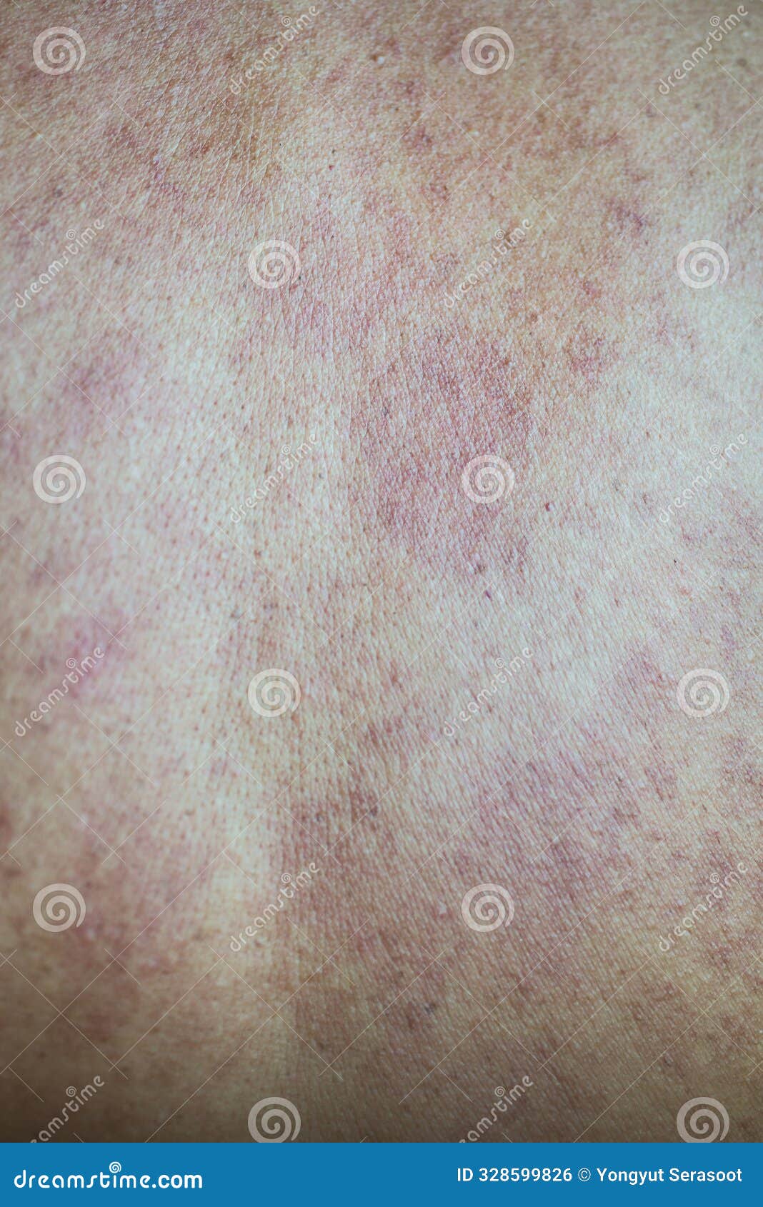 Old Red Rash Scab Wound On Asian Woman Leg Stock Photo | CartoonDealer ...