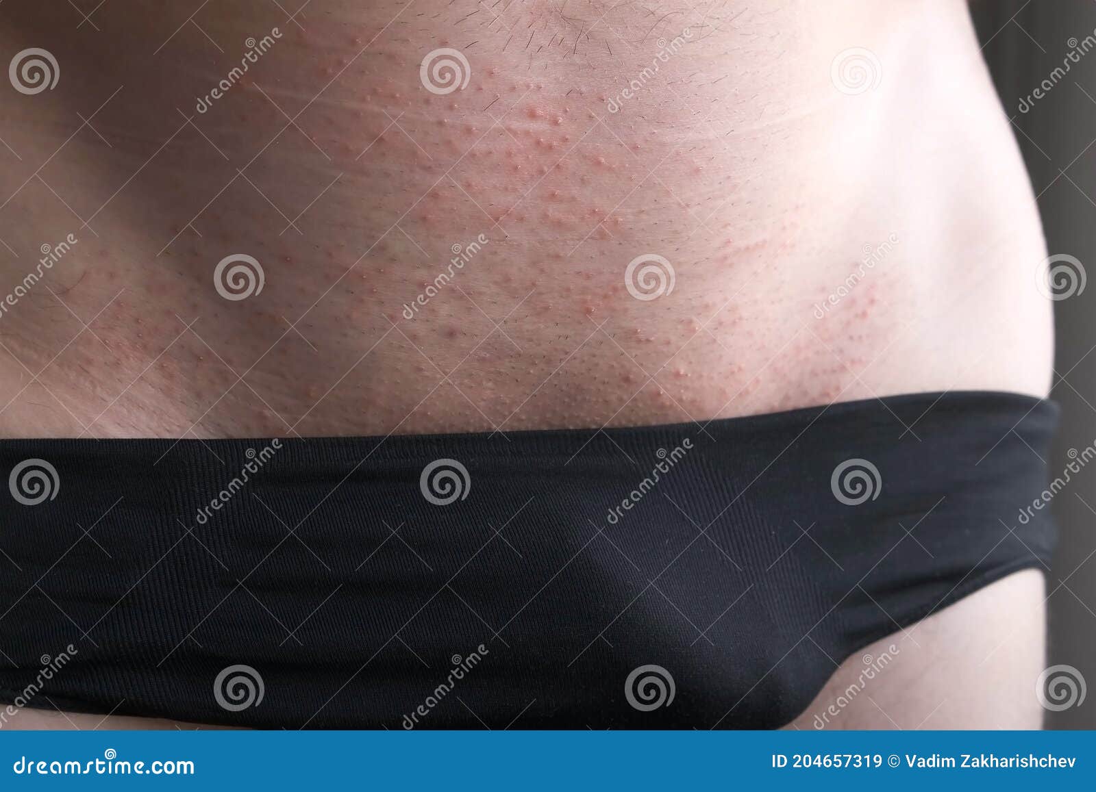 Rash On The Skin Of A Man In The Groin Area The Concept Of Venereal Diseases Stock Image