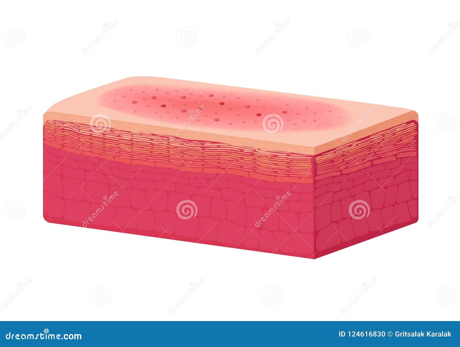 Rash on skin stock illustration. Illustration of care - 124616830