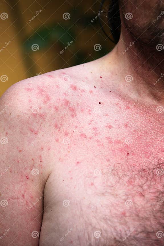 Rash or sun allergy stock photo. Image of allergies, pimples - 14962602