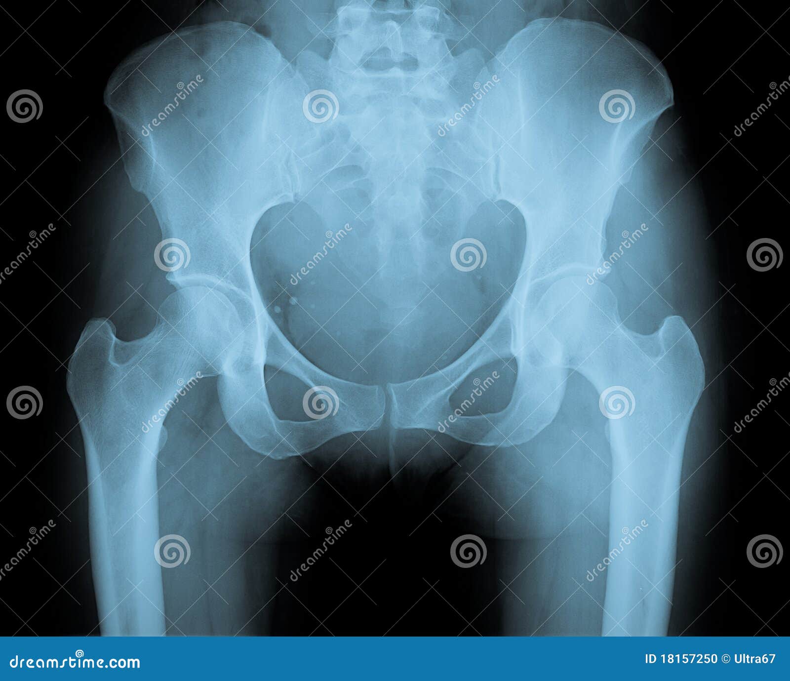 Rayo de la pelvis X foto de archivo. Imagen de pelvis - 18157250