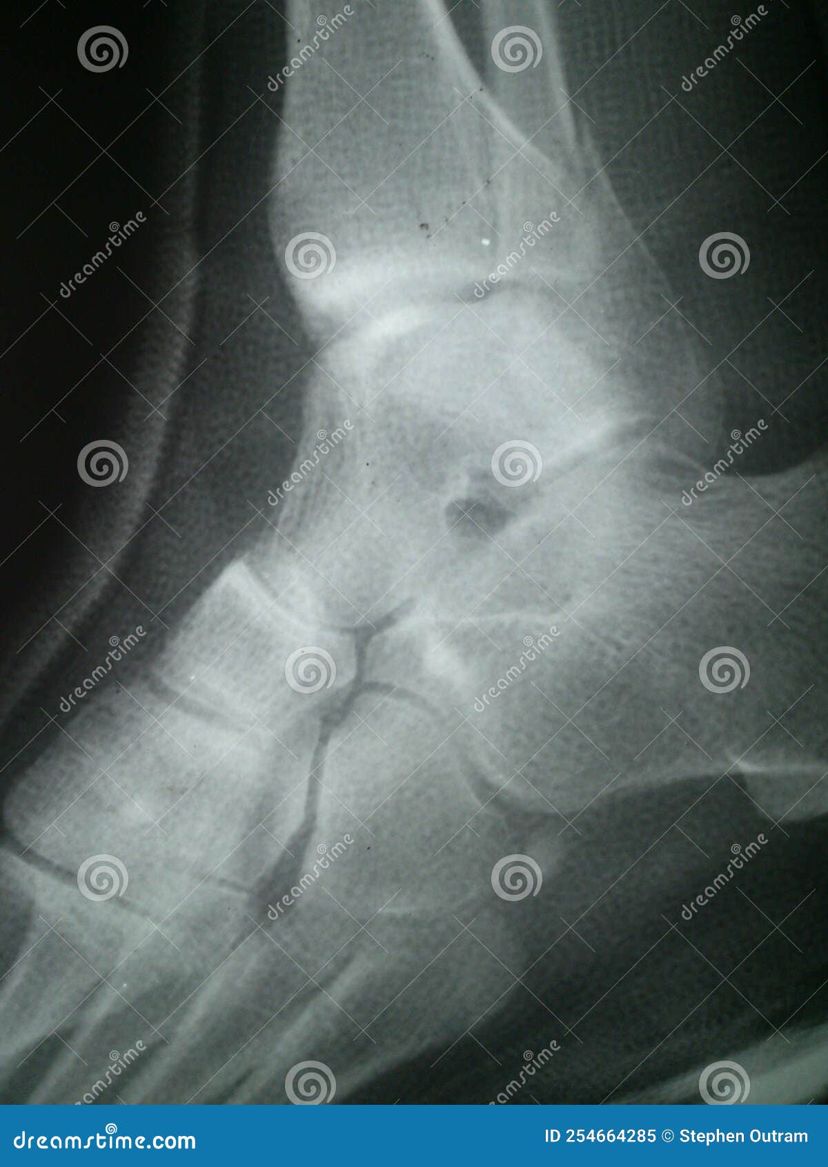 Rayo x de tobillo roto imagen de archivo. Imagen de metatarsiano ...