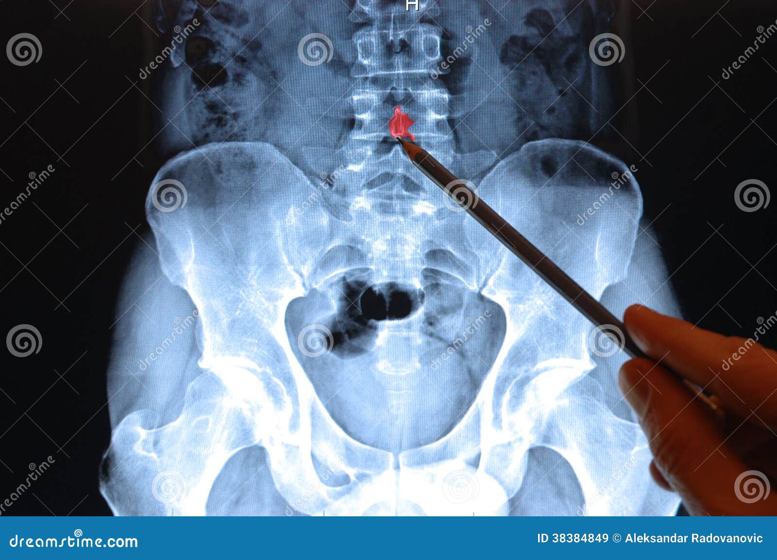 Rayo x imagen de archivo. Imagen de esquelético, paciente - 38384849