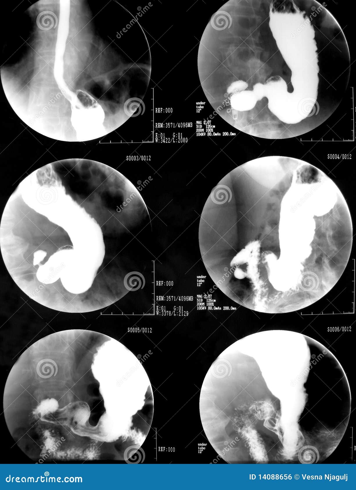 Rayon X d'estomac photo stock. Image du médecine, estomac - 14088656