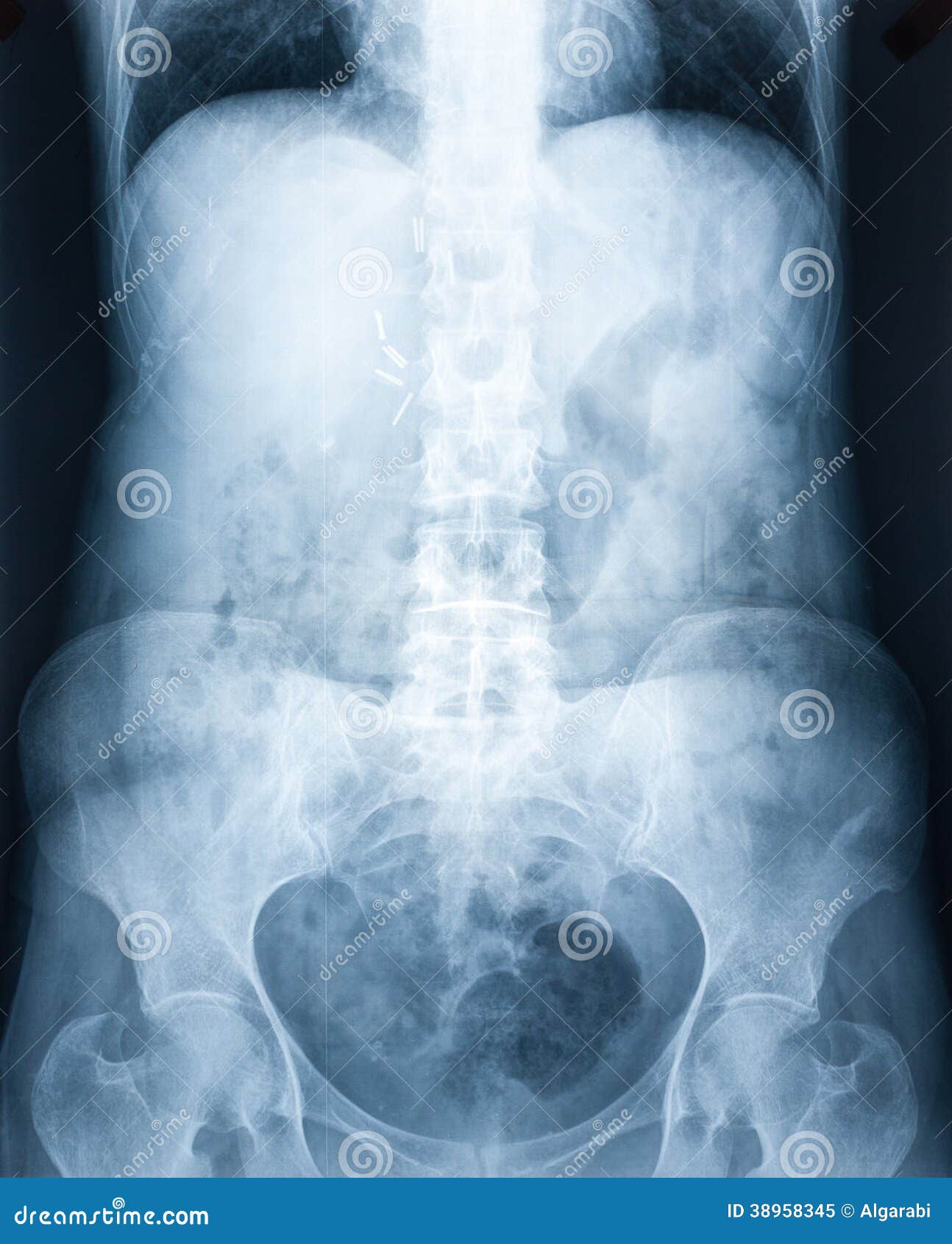 Rayon X D'un Abdomen Humain Image stock - Image du inspection ...