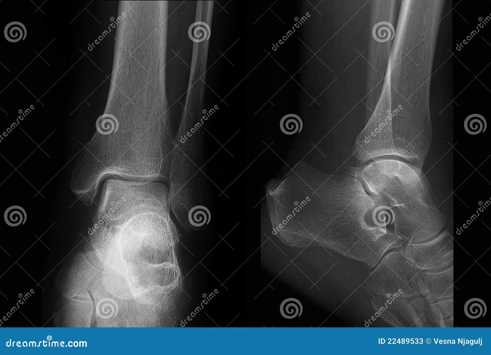 Rayon X De Cheville-radiographie Dans Deux Projections Image stock ...