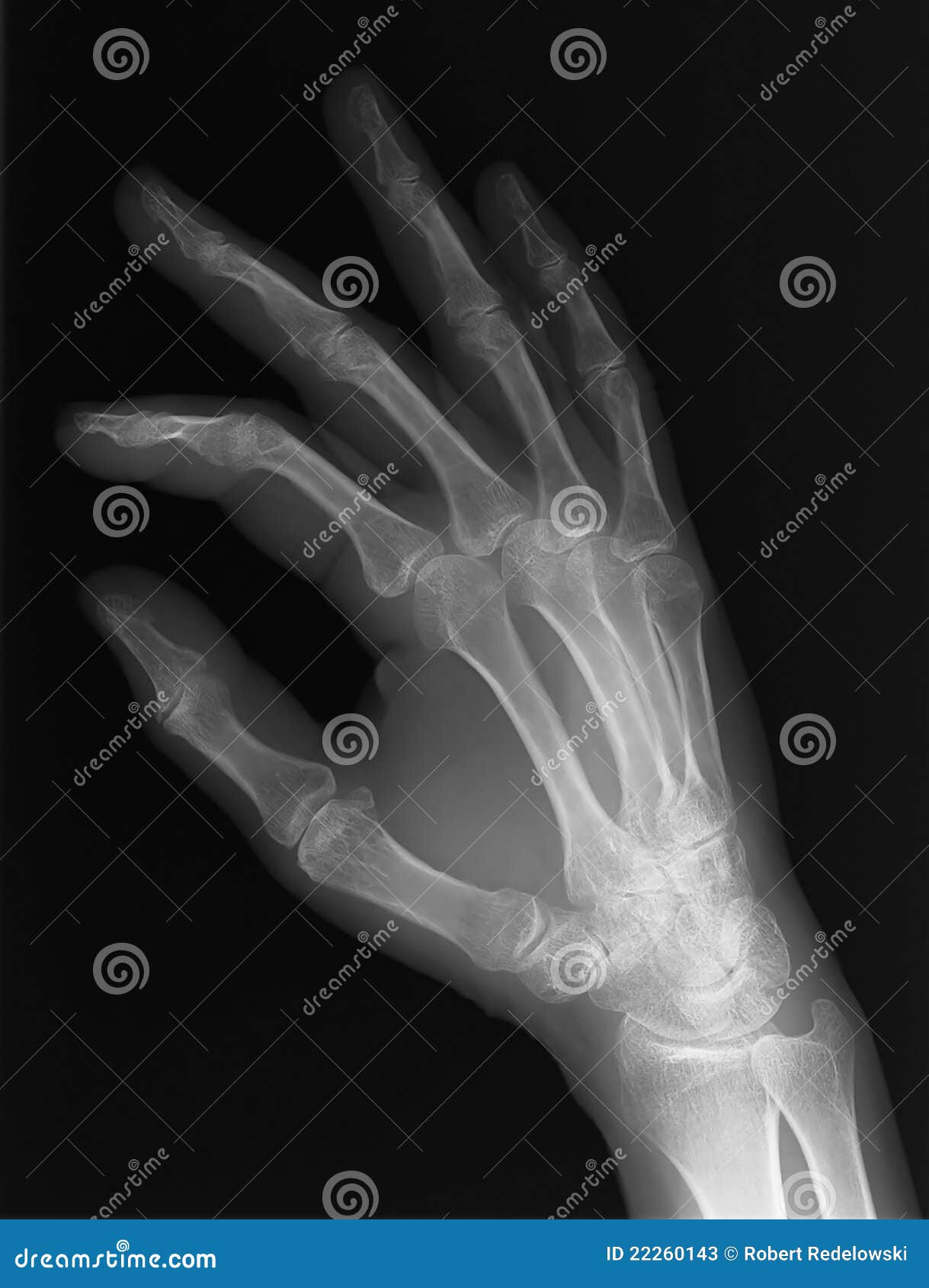 Rayon X de main image stock. Image du maladie, image - 22260143