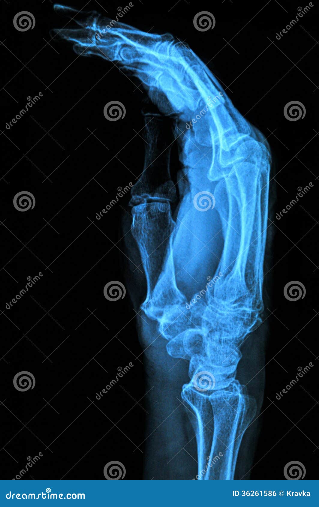 Rayon X de main photo stock. Image of chirurgie, diagnostic - 36261586