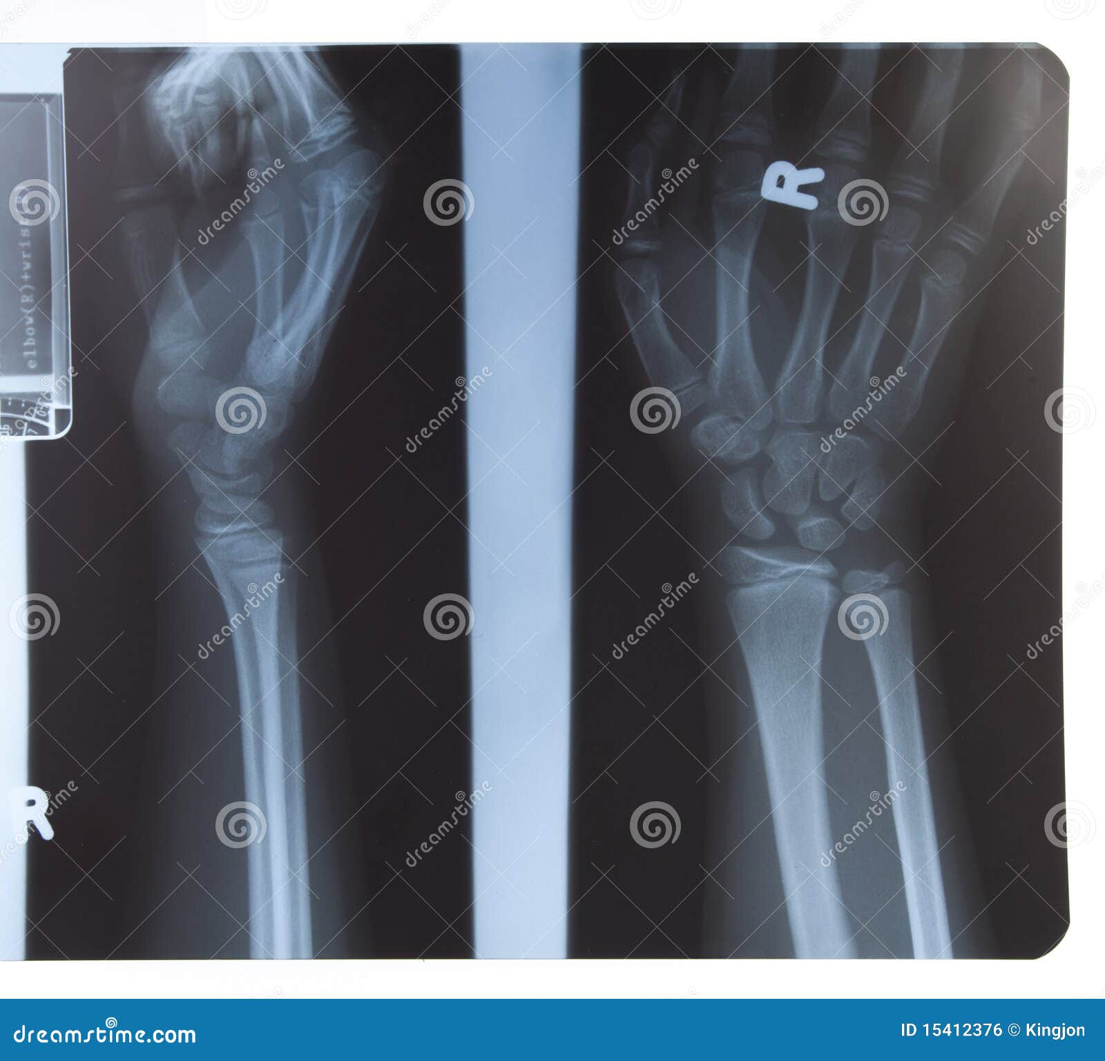 Rayon X De Main Et D'avant-bras Photo stock - Image du humain, cassé ...