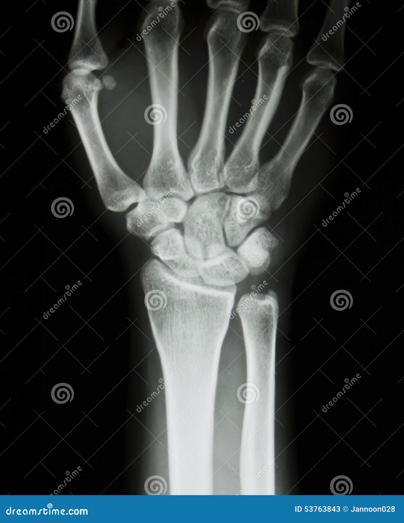 Rayon X de main humaine image stock. Image du extrémité - 53763843