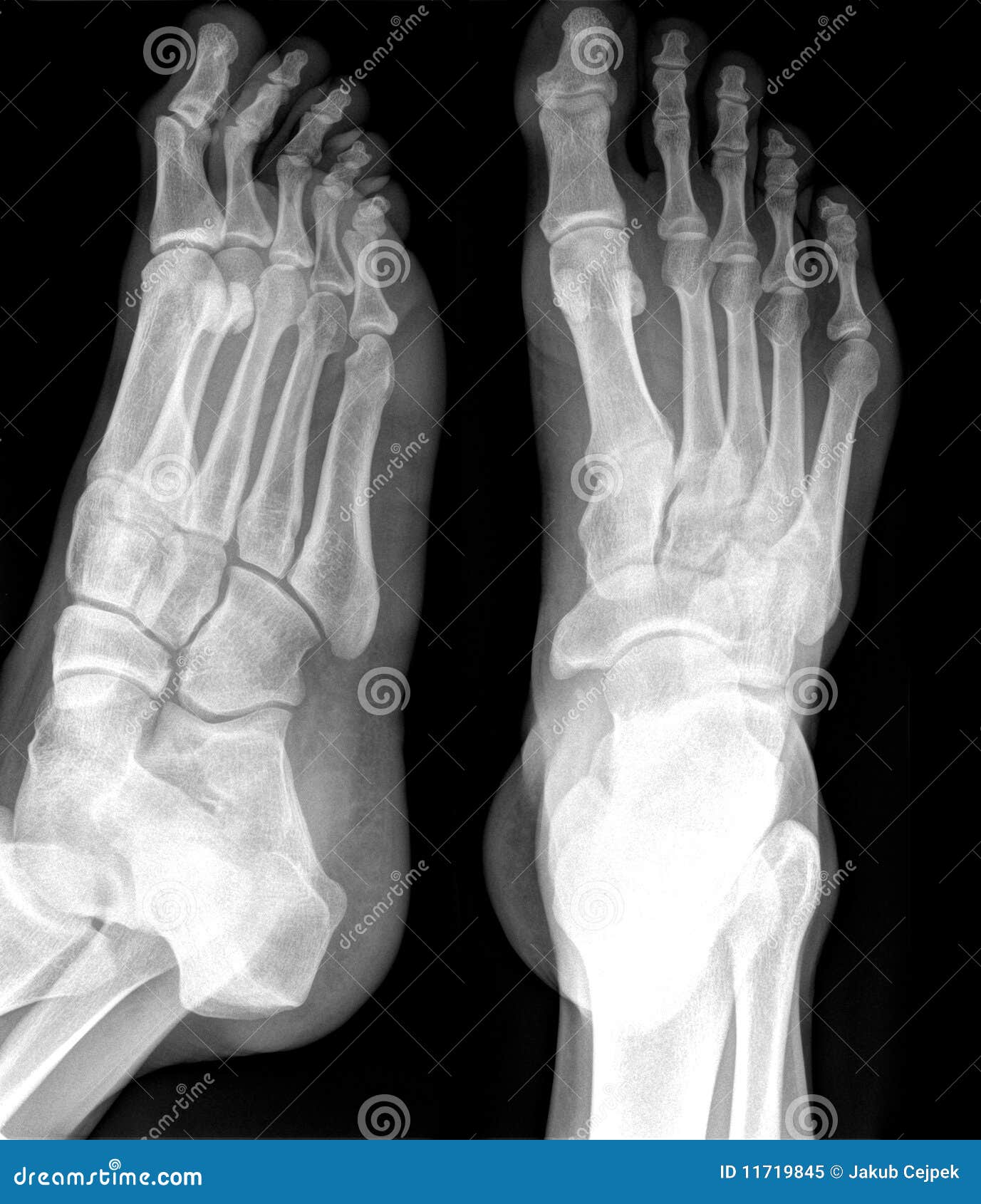 RAYON X de pied image stock. Image du santé, urgence - 11719845